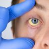 Gelbsucht bei Leberzirrhose: Symptom der Erkrankung