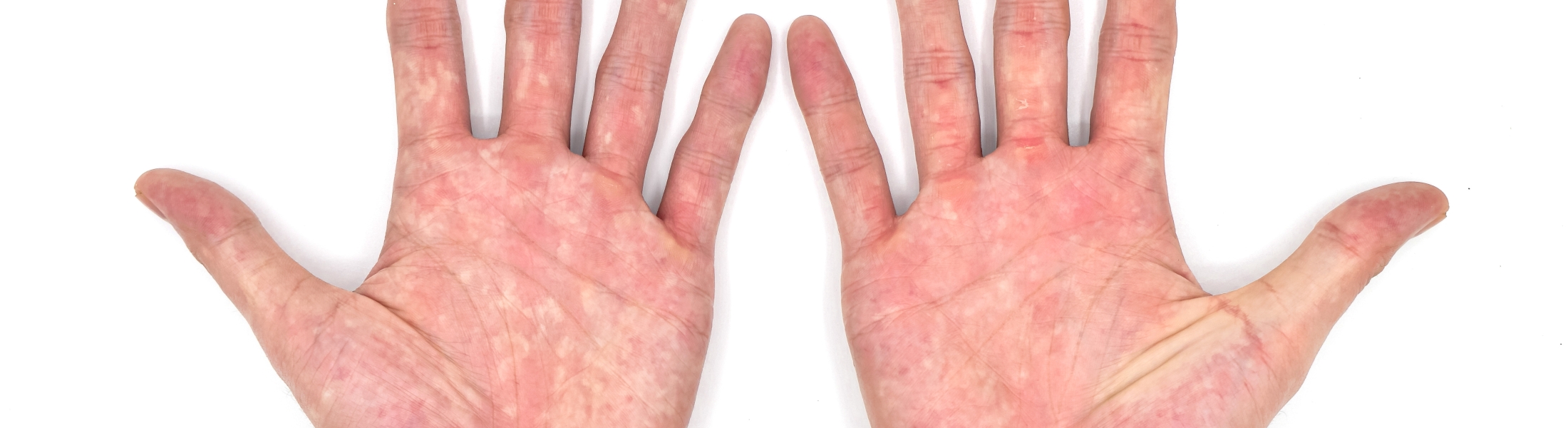 Leberhautzeichen: mögliche Hinweise auf Leberzirrhose